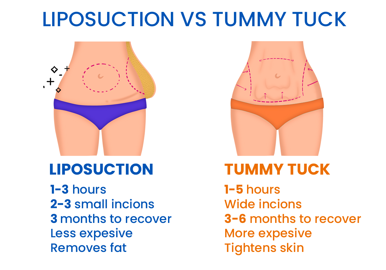 Liposuction vs Tummy Tuck: The Difference Explained